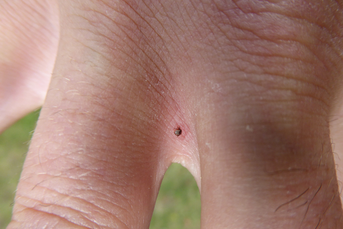 Hoe herken je een teek op je huid? - Biowetenschappen & Maatschappij